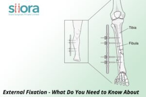 External Fixation - What Do You Need to Know About - Siora Surgicals ...