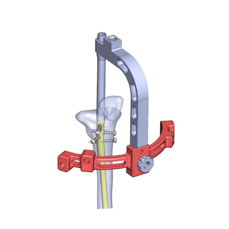 Interlocking Nailing System - Siora Surgicals Private Limited