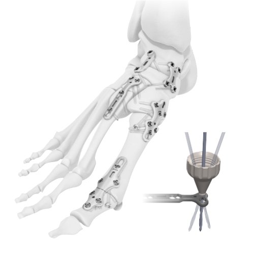 Locking Plate System - Siora Surgicals Private Limited