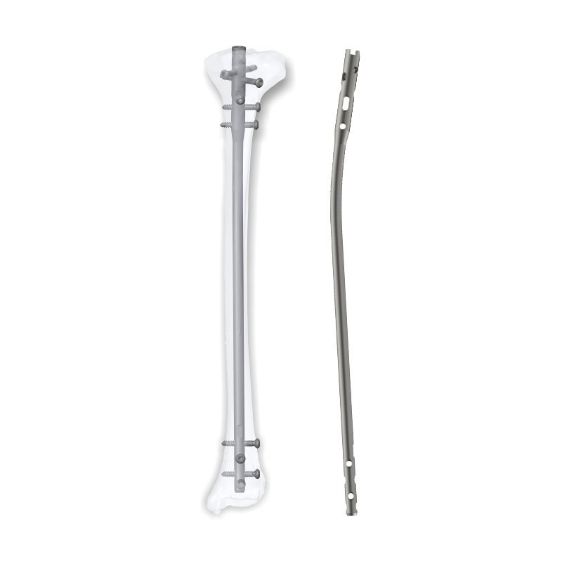 Aduera™ Expert Tibia Nail - Titanium - Siora Surgicals Pvt. Ltd.